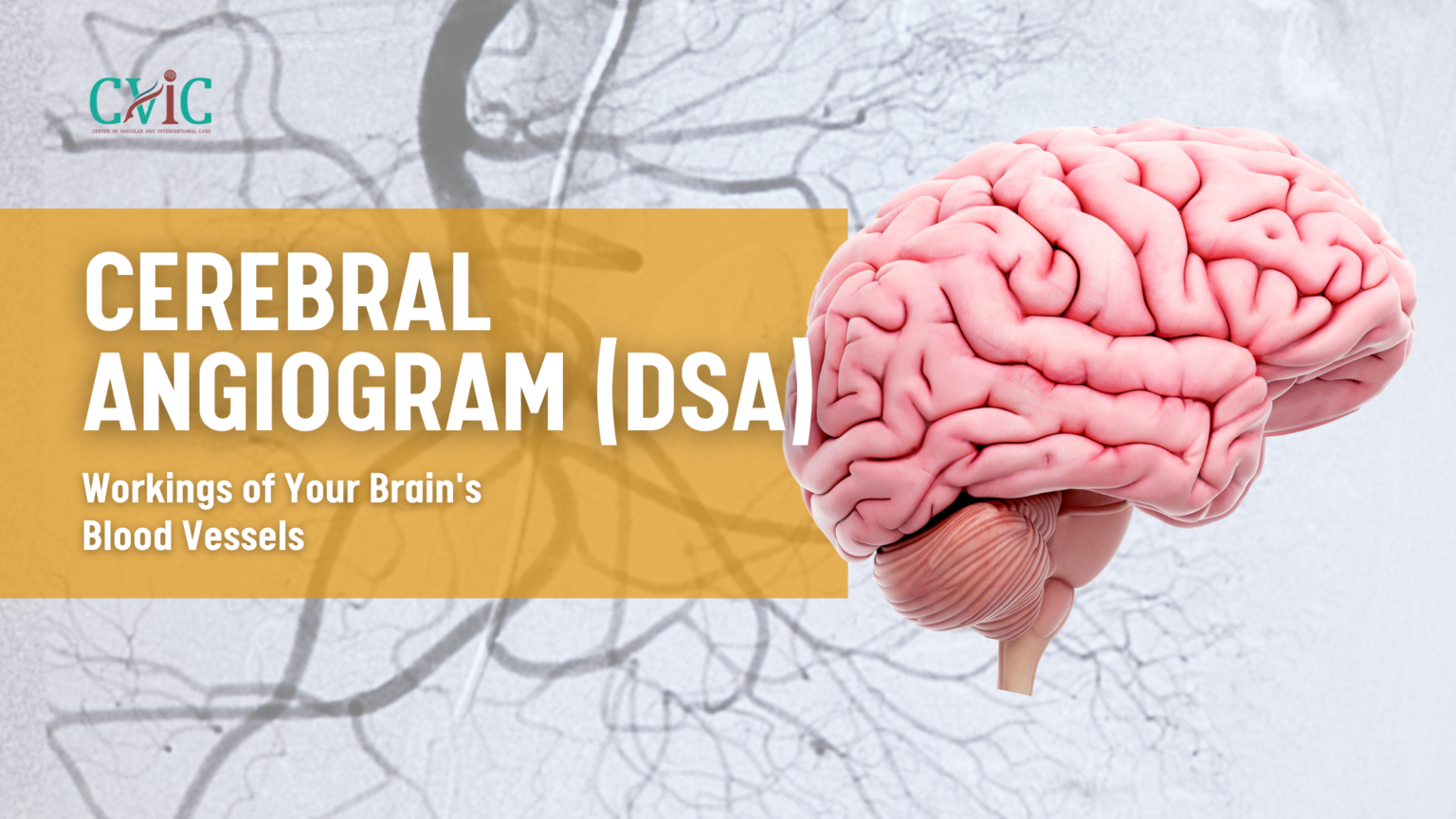 Cerebral Angiogram (DSA): Workings of Your Brain's Blood Vessels
