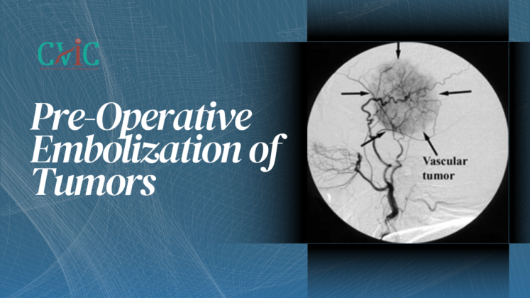 Pre-Operative Embolization of Tumors: A Lifesaving Strategy