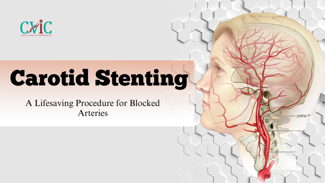 Carotid Stenting: A Lifesaving Procedure for Blocked Arteries