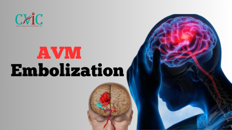 AVM Embolization: A Comprehensive Guide to the Procedure