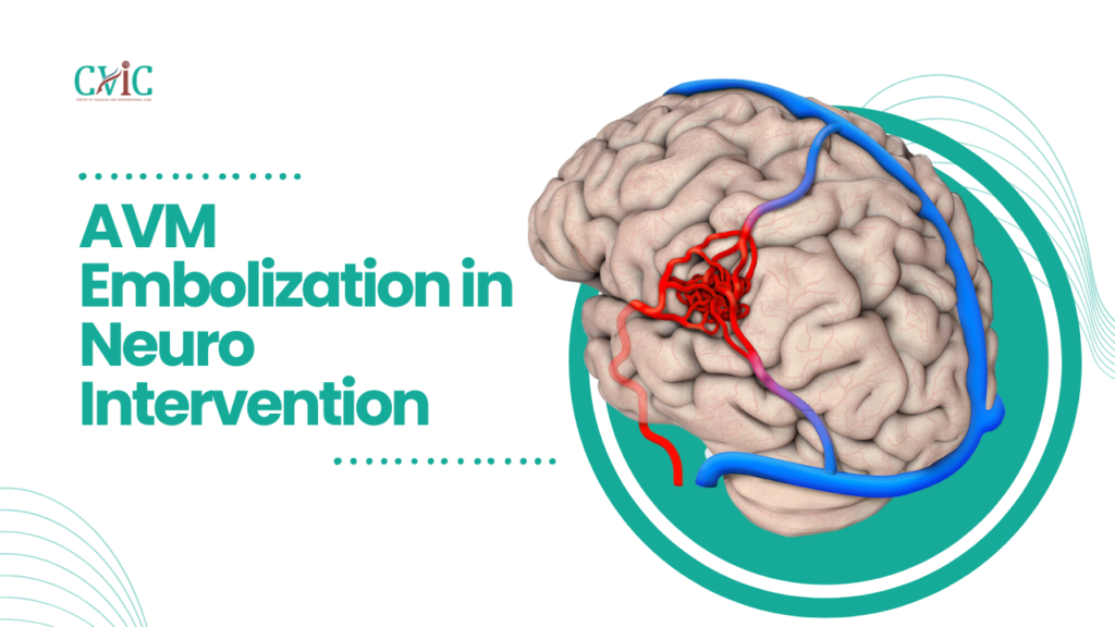 AVM Embolization in Neuro Intervention