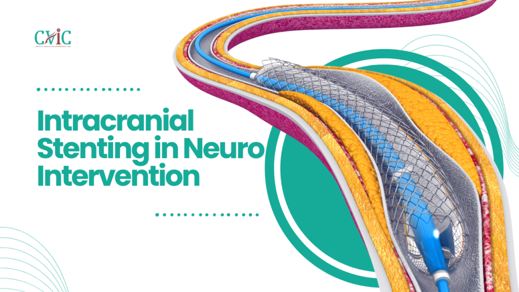 Intracranial Stenting in Neuro Intervention