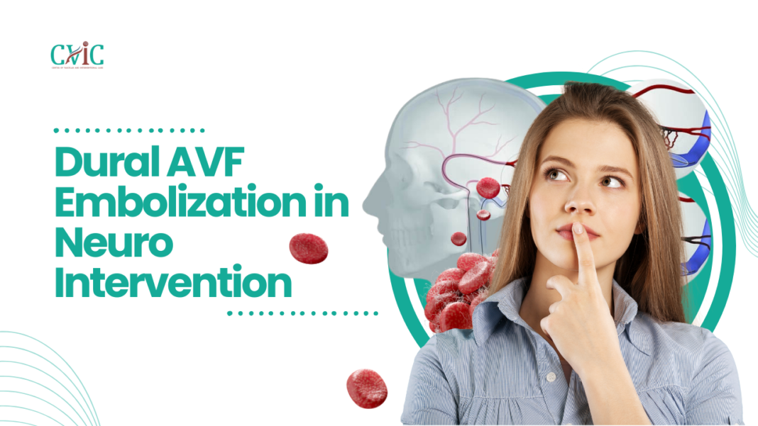 Dural AVF Embolization in Neuro Intervention