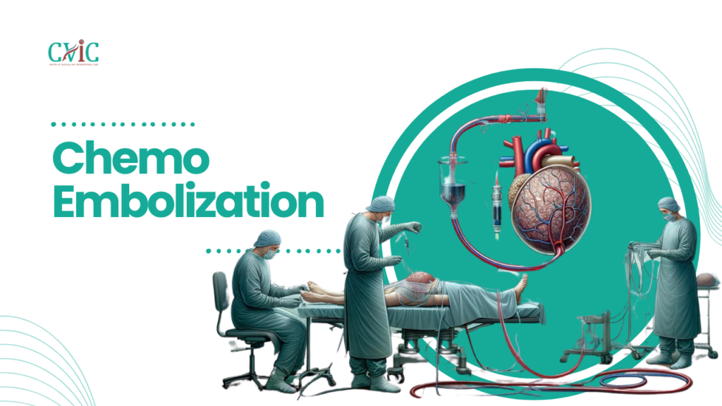 Targeted Victory: Mastering Chemo Embolization in Cancer Treatment
