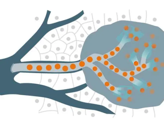 Targeted Victory: Mastering Chemo Embolization in Cancer Treatment