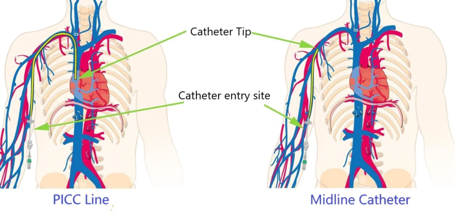 Streamlining Care: Navigating the Essentials of PICC Line Placement