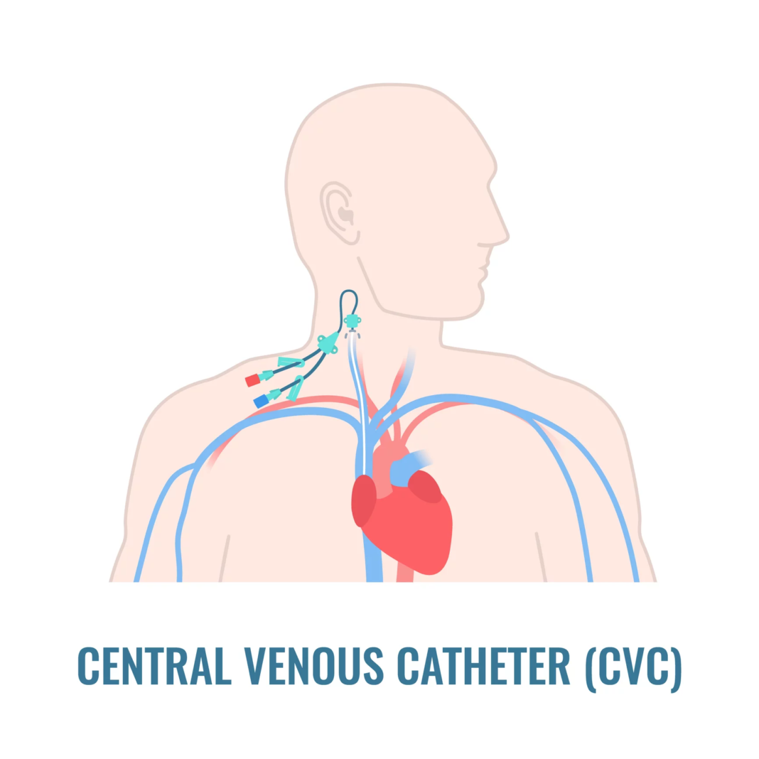 Streamlining Care: Navigating the Essentials of PICC Line Placement