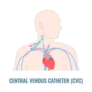 Streamlining Care: Navigating the Essentials of PICC Line Placement