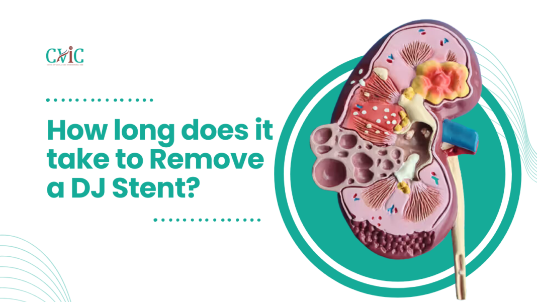 How long does it take for a DJ Stent Removal?