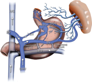 Differences Between TIPS and BRTO Procedures in Gastroenterology