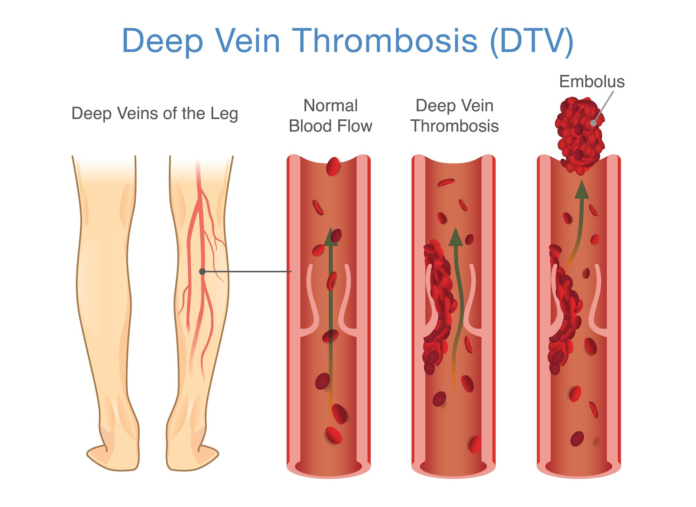 Which Management is Appropriate in Deep Vein Thrombosis?