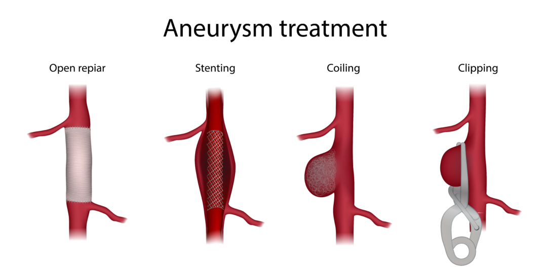 Coiling for Aneurysms: A Safe and Effective Treatment Option