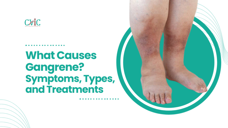 What Causes Gangrene? Understand Symptoms, Types