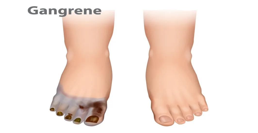 What Causes Gangrene? Understand Symptoms, Types