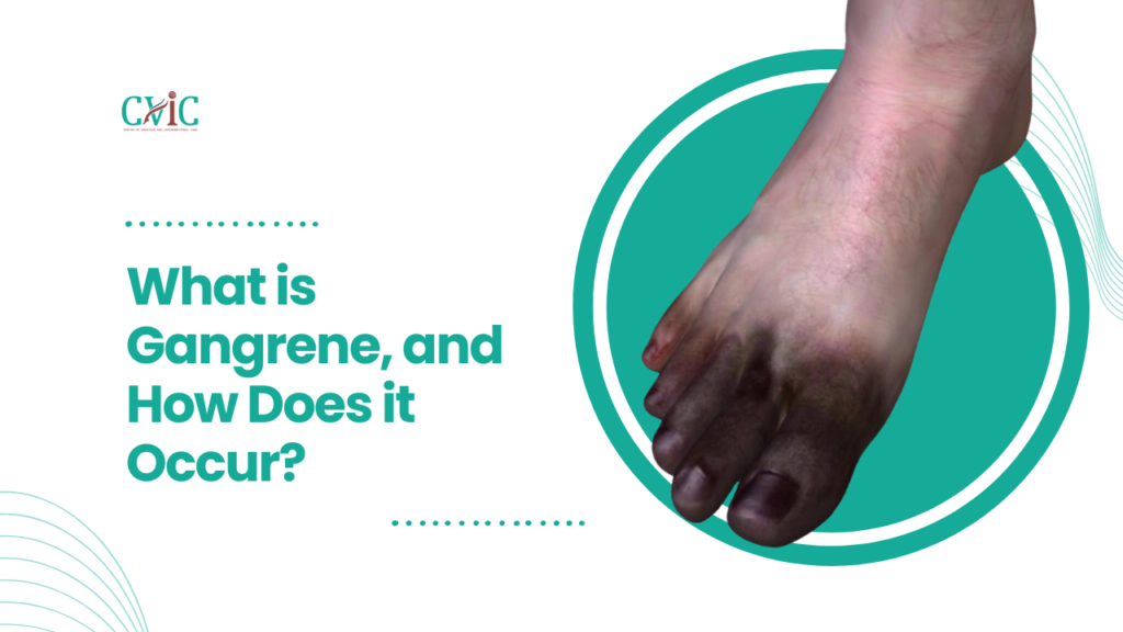 What is Gangrene, and How Does it Occur?