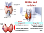 Goiters And Thyroid Nodules: Key Differences, Causes
