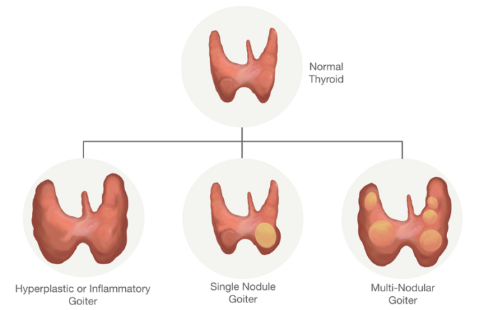 Goiters And Thyroid Nodules: Key Differences, Causes
