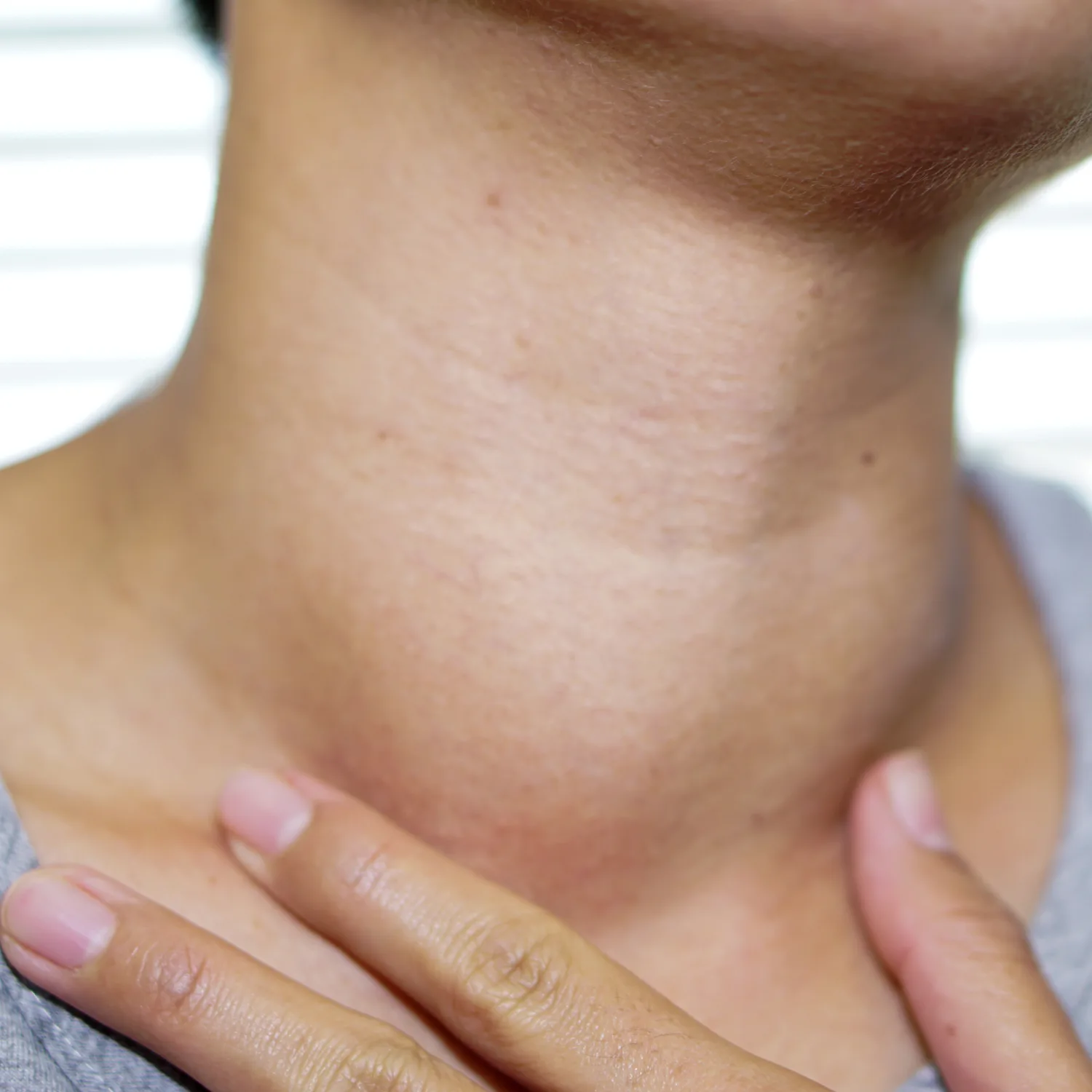 Thyroid Goiter: Top 10 Causes, Symptoms, and Effective Treatment