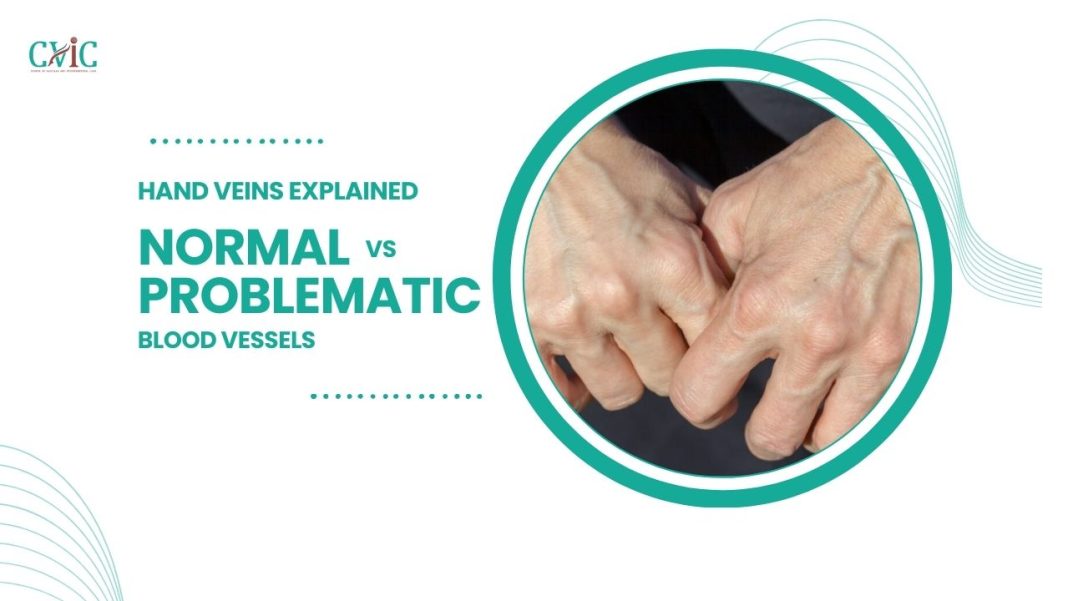 Hand Veins Explained: Normal vs. Problematic Blood Vessels ...
